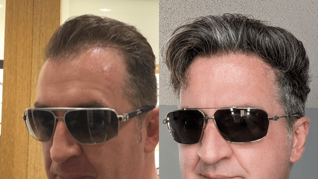 Amazing Hair Regrowth! 10,000 New Hairs in 3 Months! - NewHairFormula